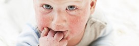 Comprendre l'eczéma des enfants