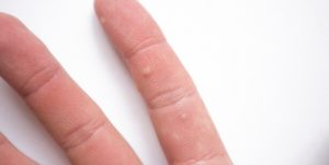 Comment enlever une verrue : 5 astuces naturelles efficaces