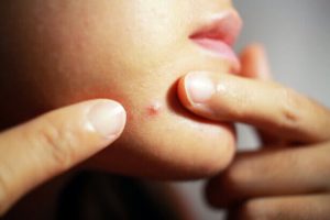 Trucs et astuces : lutter contre l'acné et les boutons