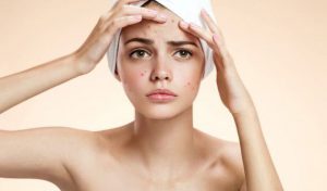 Des solutions naturelles pour lutter contre un bouton de stress ou d'acné