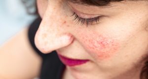 Qu'est-ce que la couperose et comment la soulager