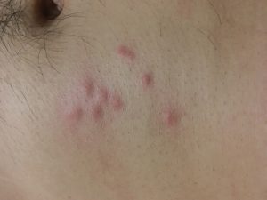 10 conseils naturels contre les piqûres d'aoûtat