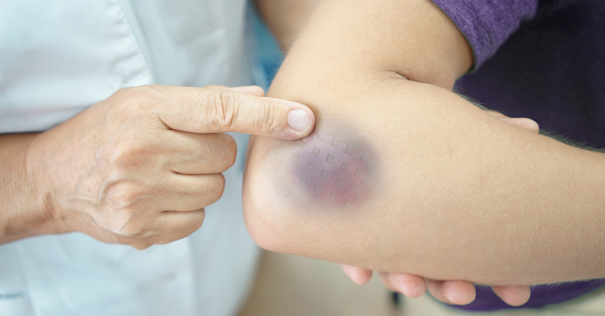 10 remèdes naturels pour faire disparaître un bleu plus vite