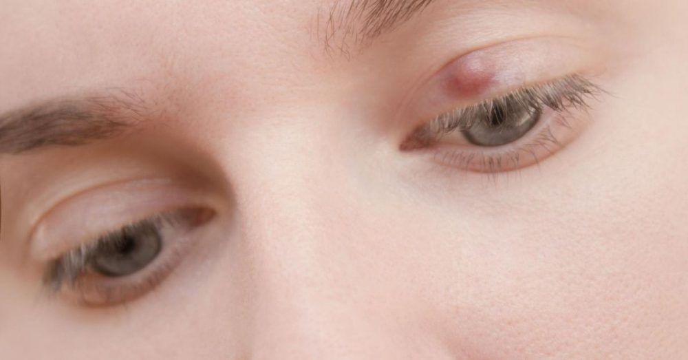 Qu'est-ce qu'un orgelet